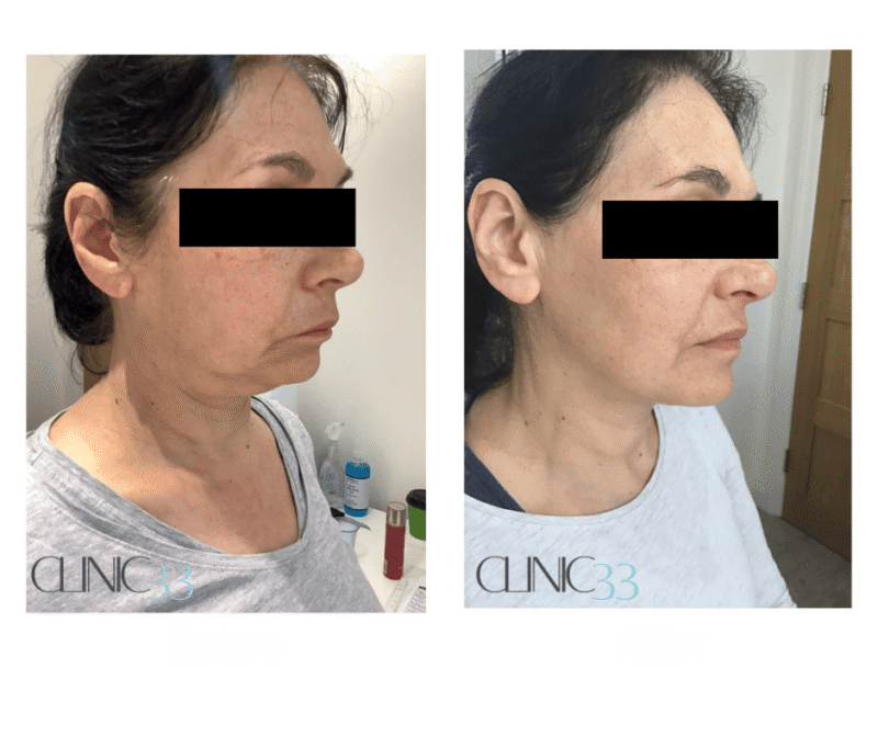 Understanding Stubborn Chin Fat | Clinic 33
